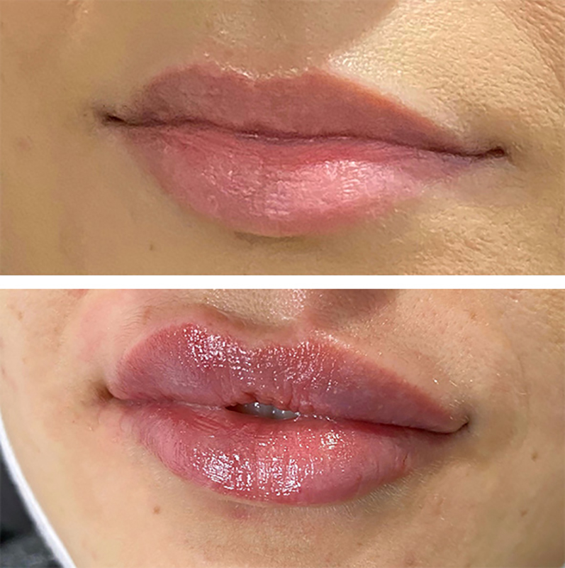 Lip Augmentation Boston | Boston Medical Aesthetics