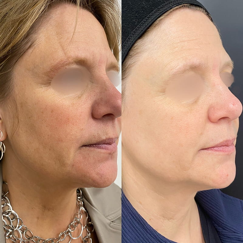 Lumecca IPL PhotoFacials Boston | Skin Rejuvenation | BMA