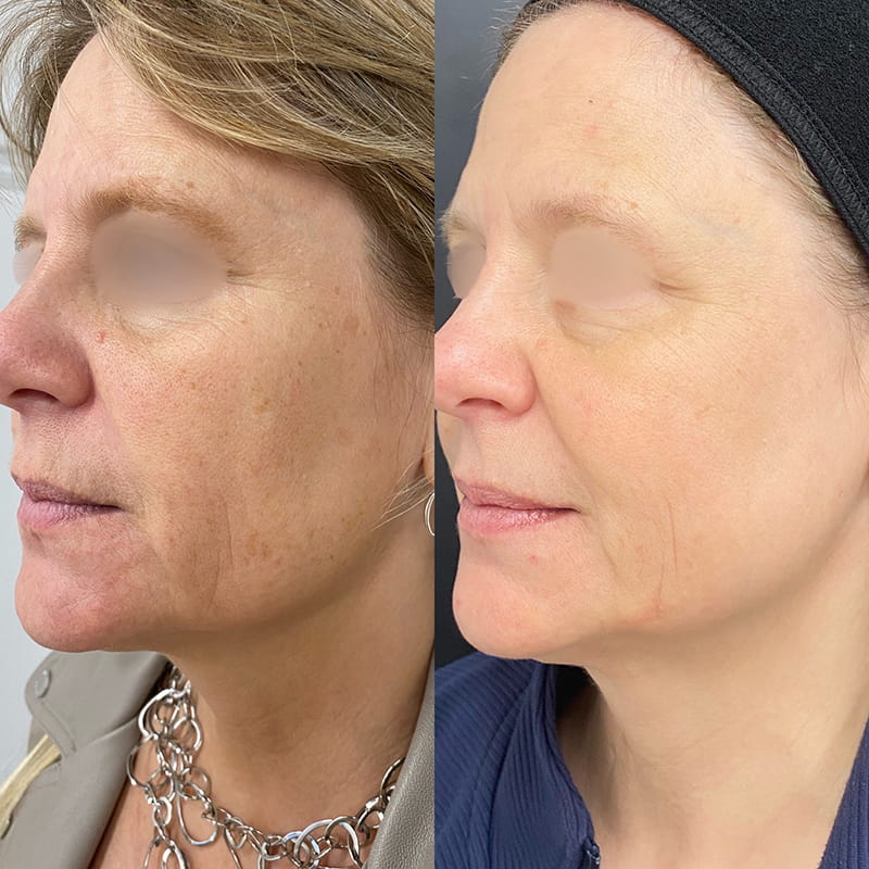 Lumecca IPL PhotoFacials Boston | Skin Rejuvenation | BMA