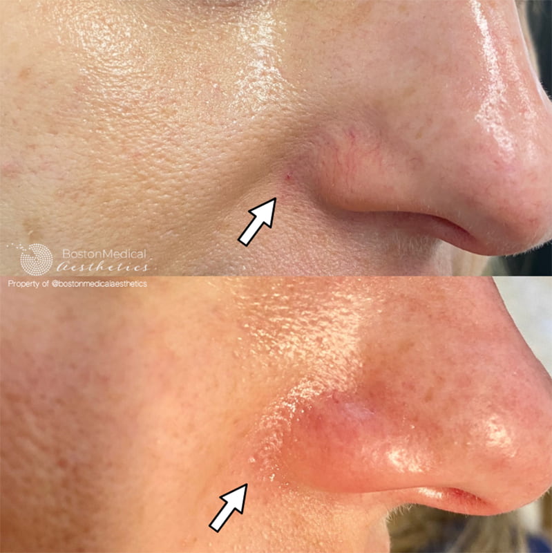 Lumecca IPL PhotoFacials Boston | Skin Rejuvenation | BMA